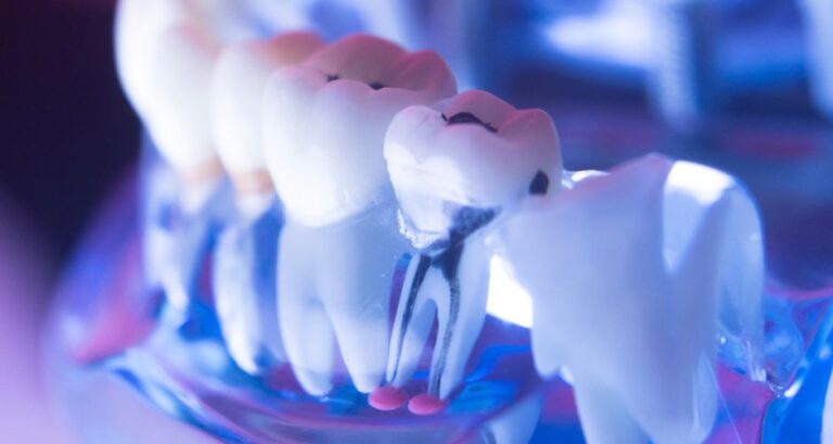 Everything You Need to Know About Root Canal Treatment